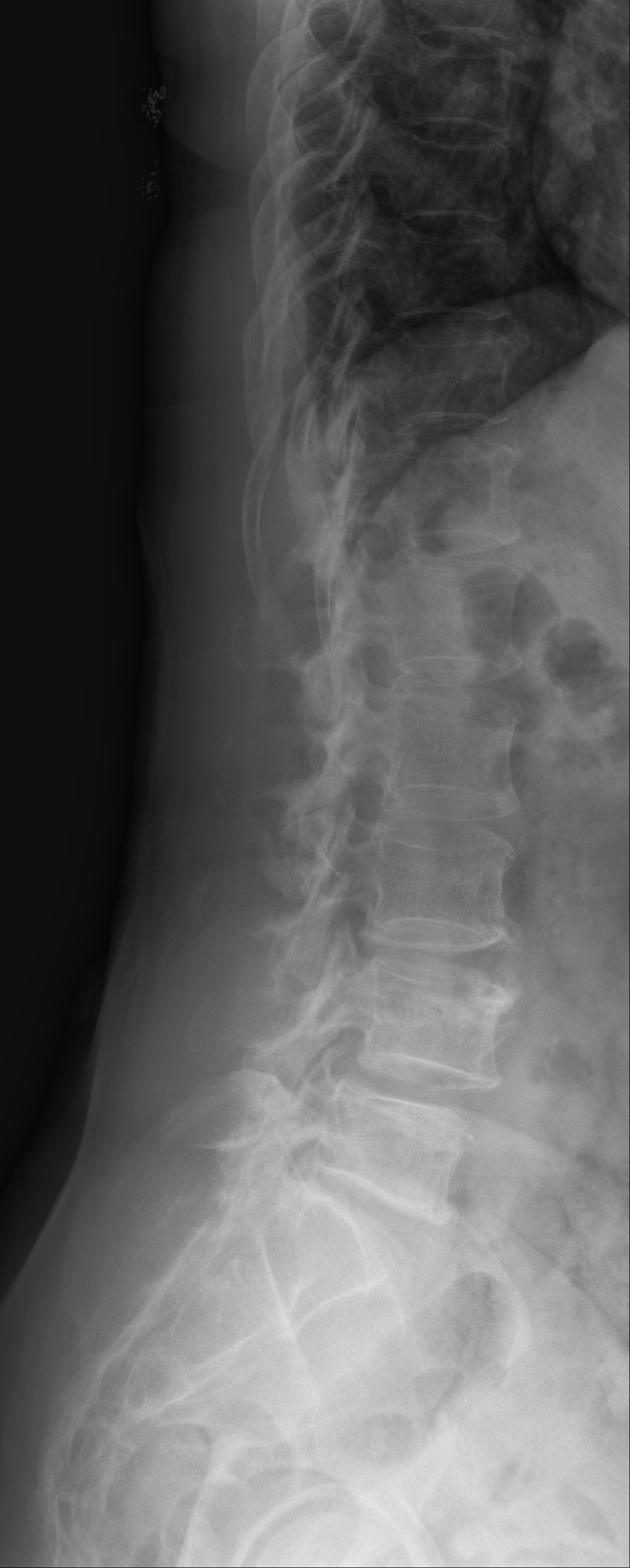 Spondylolisthesis Classification Model by Logans Work Space