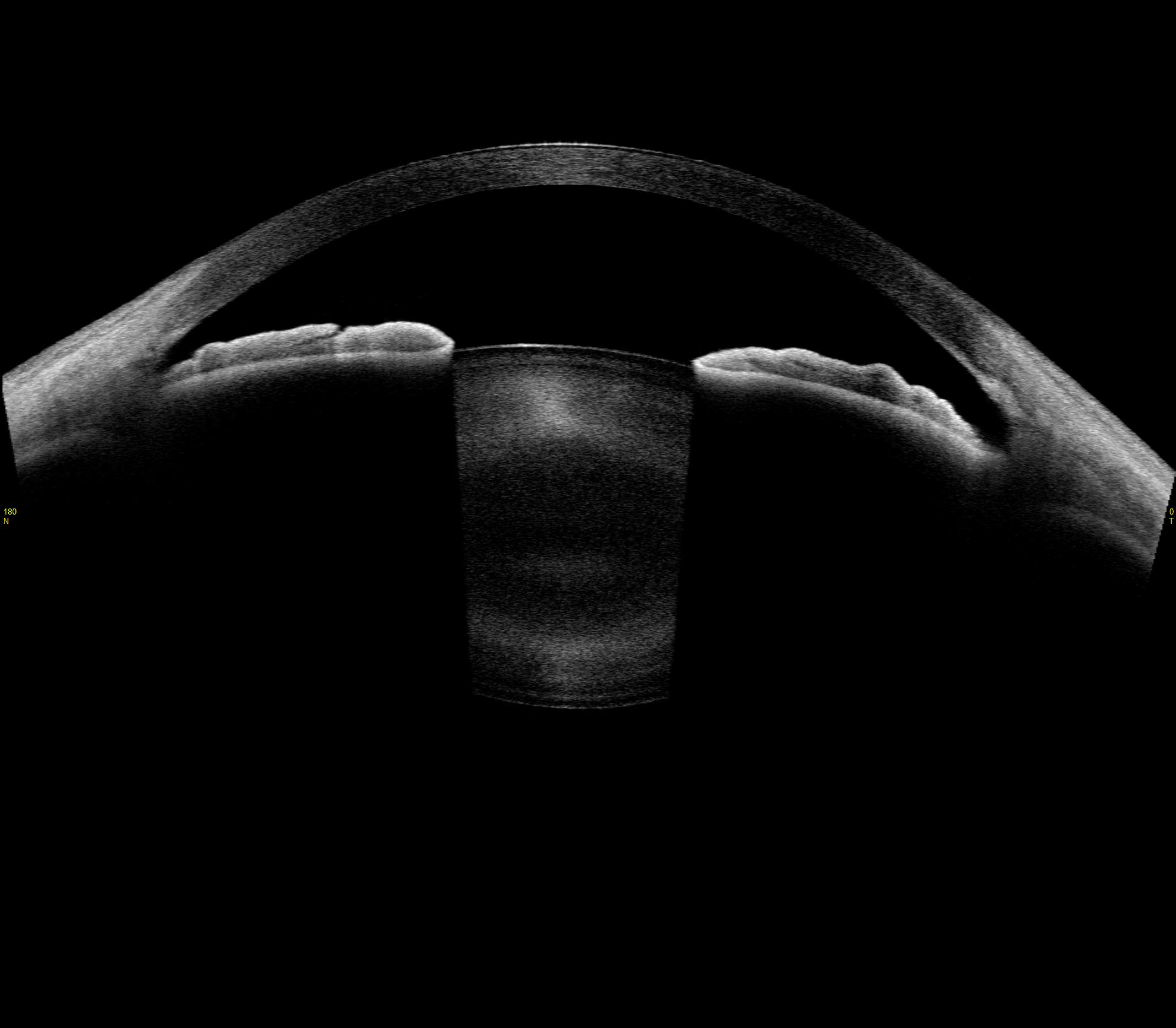 Cataract Lens Data - Roboflow Universe