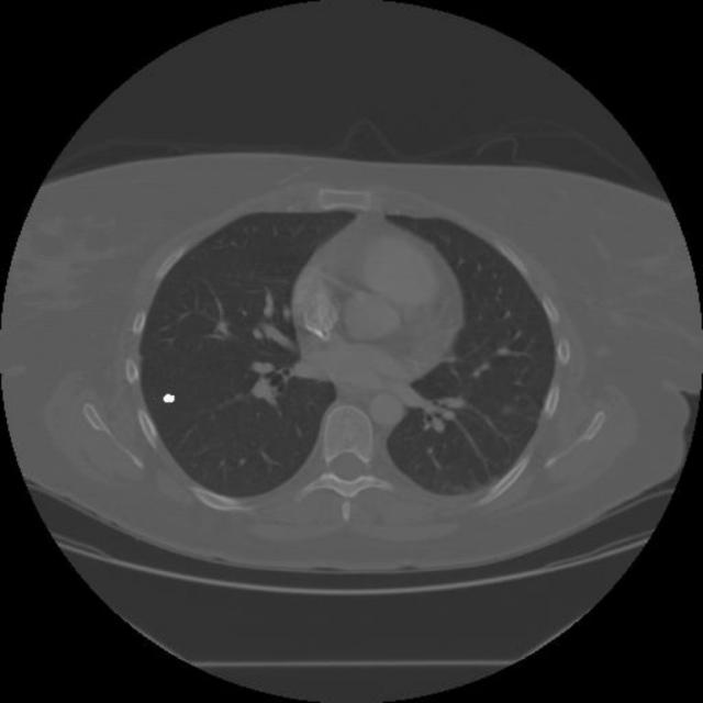 pulmone Object Detection Model by KEVIN ponce