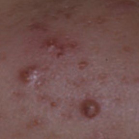 ACNE DATASET YOLOv5 Object Detection Dataset by ForHW2