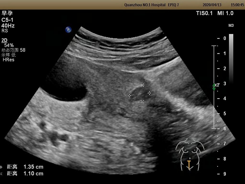Mini Project Instance Segmentation Dataset and Pre-Trained Model by Uterine Cancer
