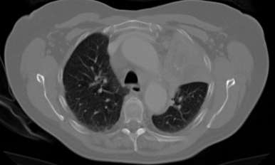 LCD_DATASET2 Classification Dataset by lung cancer