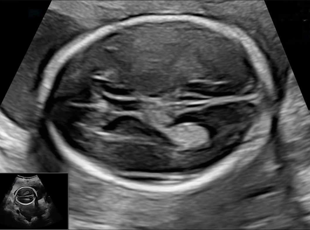 Tranventricular Roboflow Instance Segmentation Model by Yadi Utama
