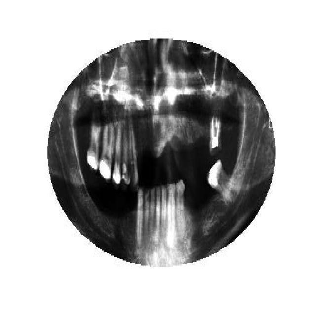 DRD removed cavity class Object Detection Model by new-workspace-r6ynr