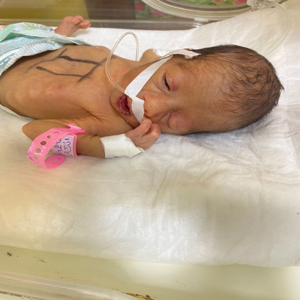 Jaundice Dataset v2 Object Detection Model by Tugas