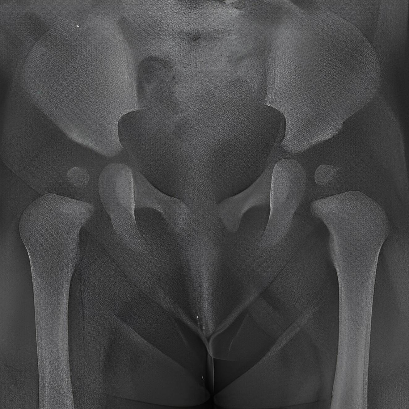 ddh Classification Dataset by AICA