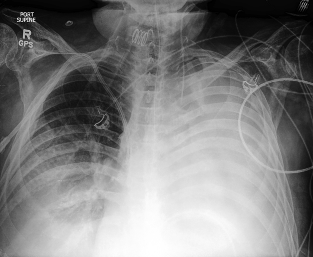 CheXpert Classification Dataset and Pre-Trained Model by AIMI
