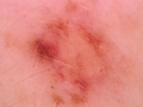 Skin Cancer Object Detection Dataset And Pre Trained Model By Emirake