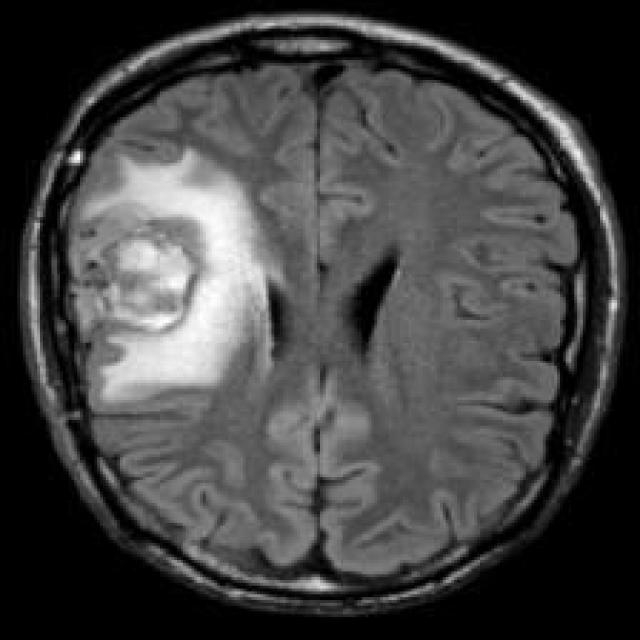 brain-tumor-sam Instance Segmentation Dataset by IOT INATEL