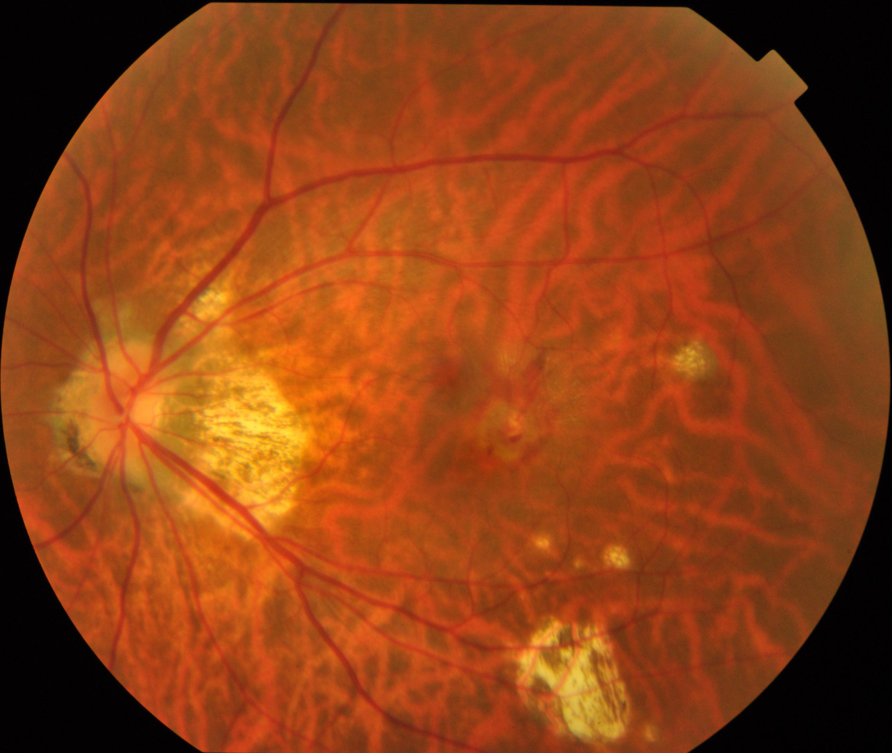 Fundus Classification Dataset and Pre-Trained Model by Abhay Lejith