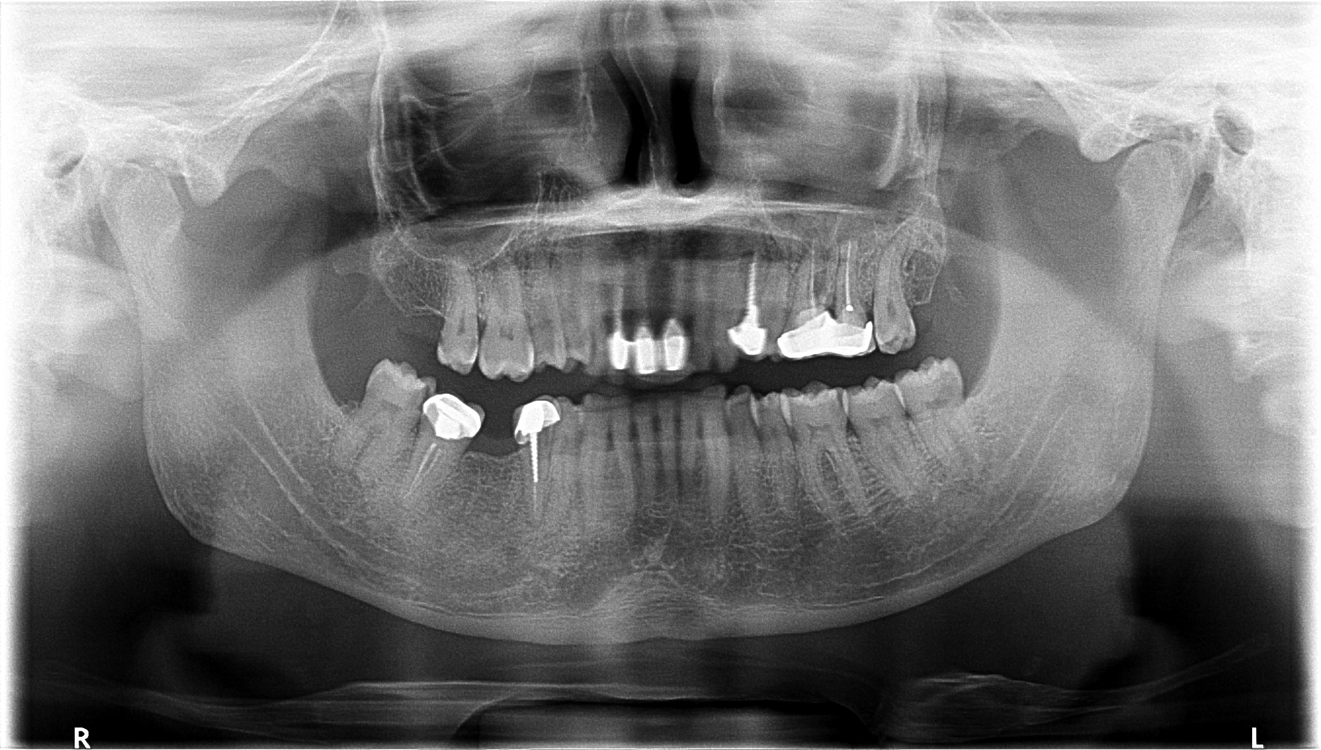How to Use the tooth-xray-detection Object Detection API