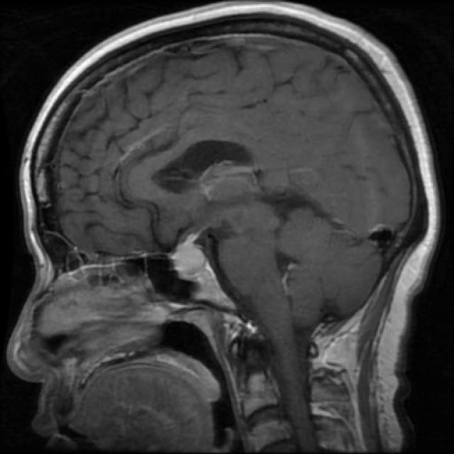 brain tmor detection yolo - Roboflow Universe