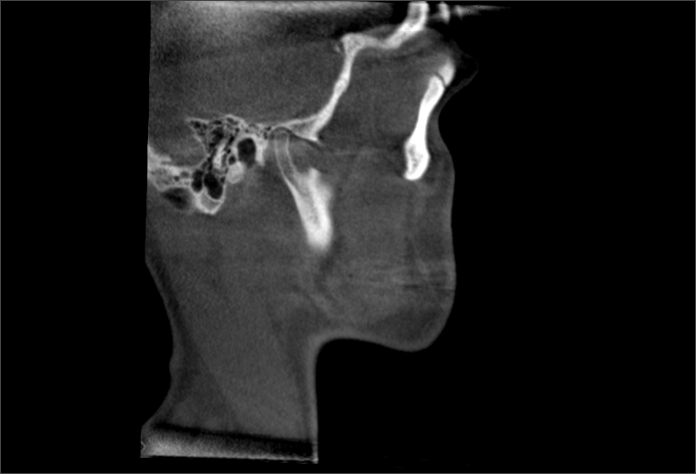 TMJ Instance Segmentation Dataset and Pre-Trained Model by CT scan OF THE TMJ