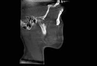 CT scan OF THE TMJ - Roboflow Universe