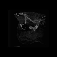 CT scan OF THE TMJ - Roboflow Universe