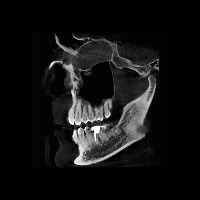 CT scan OF THE TMJ - Roboflow Universe