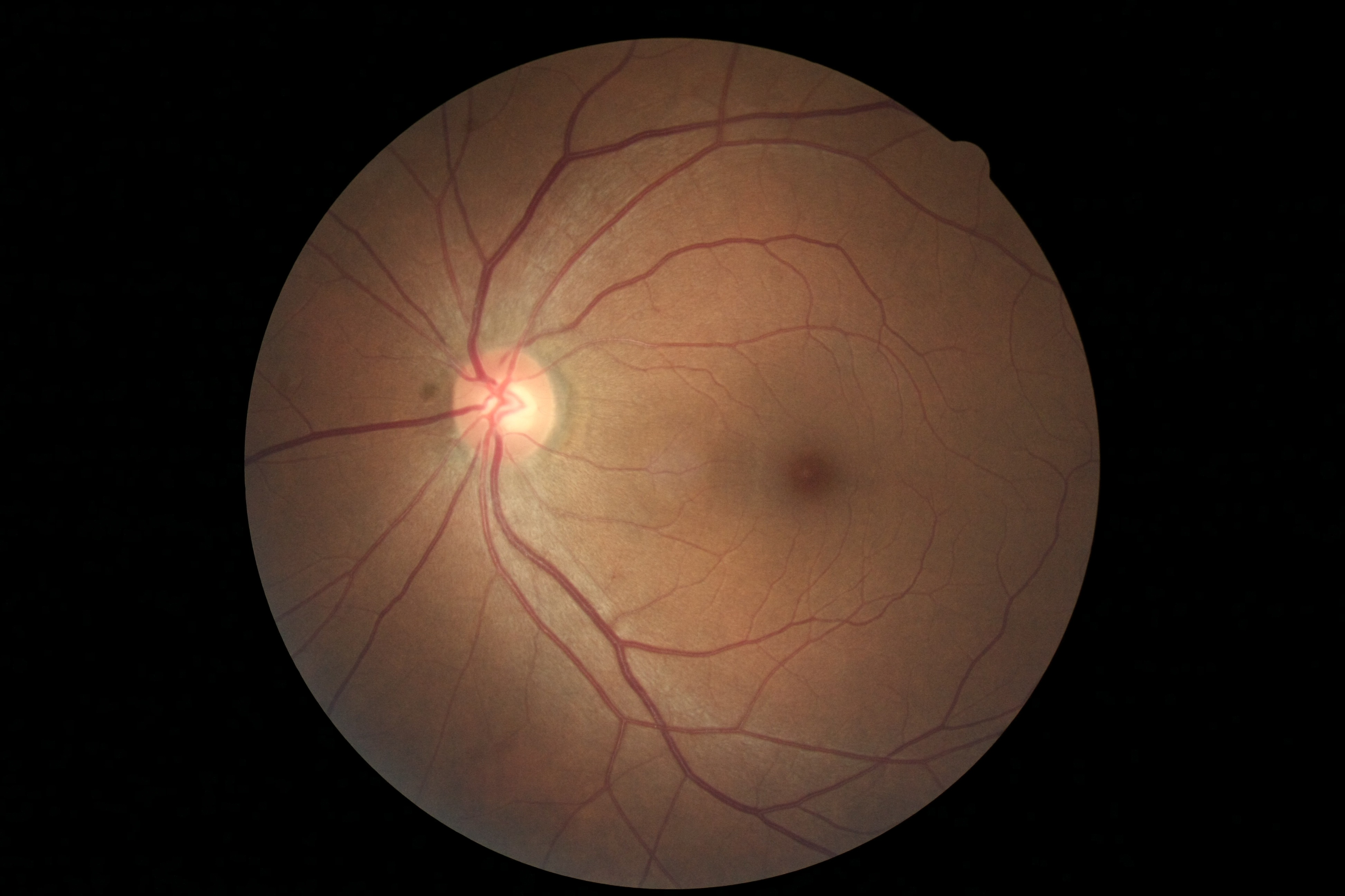 Diabetic_Retinopathy_large Classification Dataset by pose detection