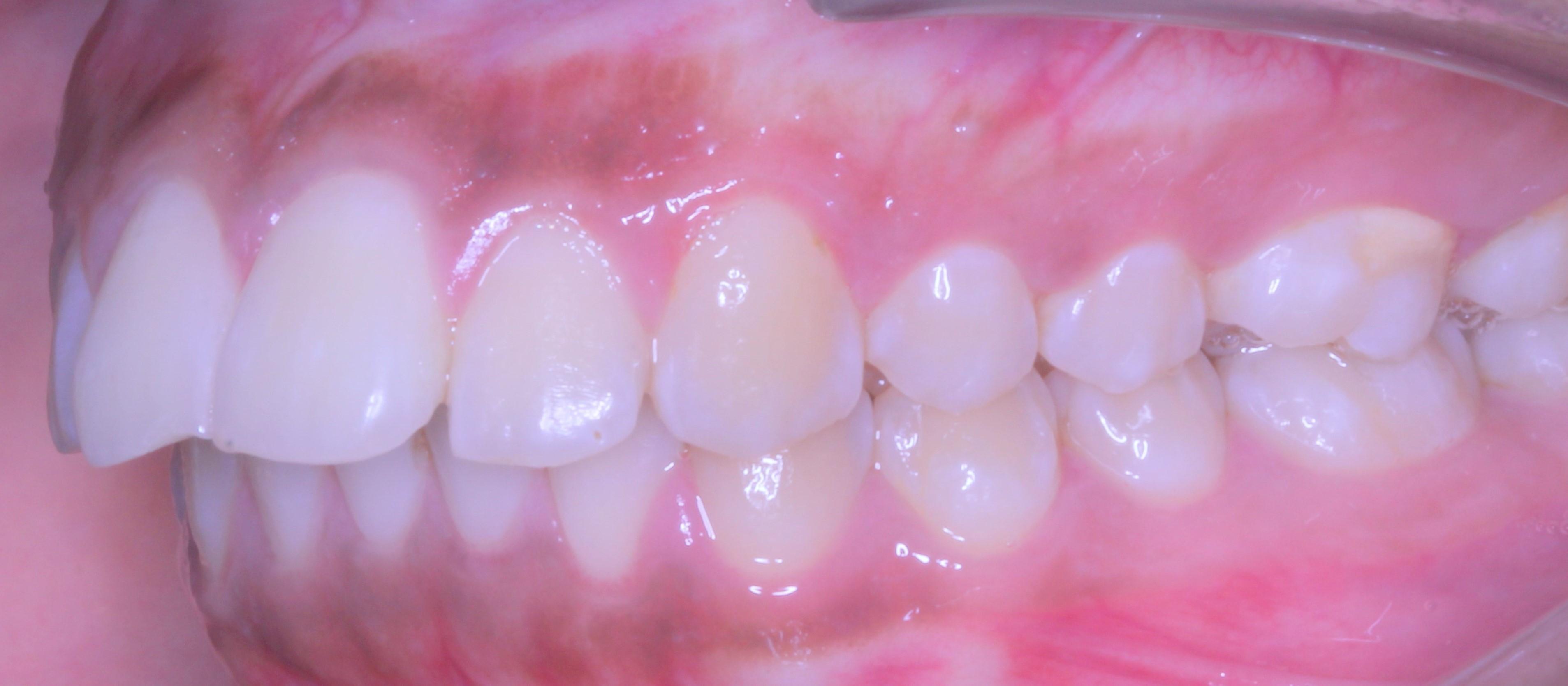 Overjet Object Detection Dataset and Pre-Trained Model by Ahmad AI