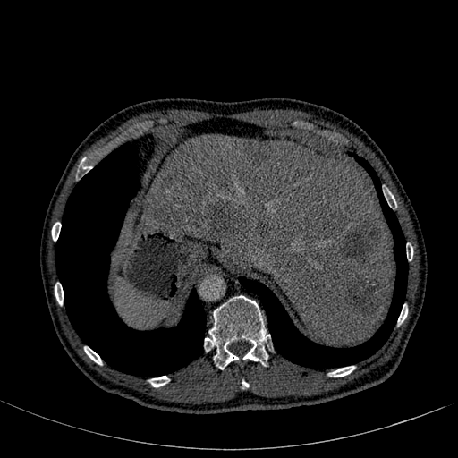 Liver_Tumor Instance Segmentation Dataset and Pre-Trained Model by brain tumor