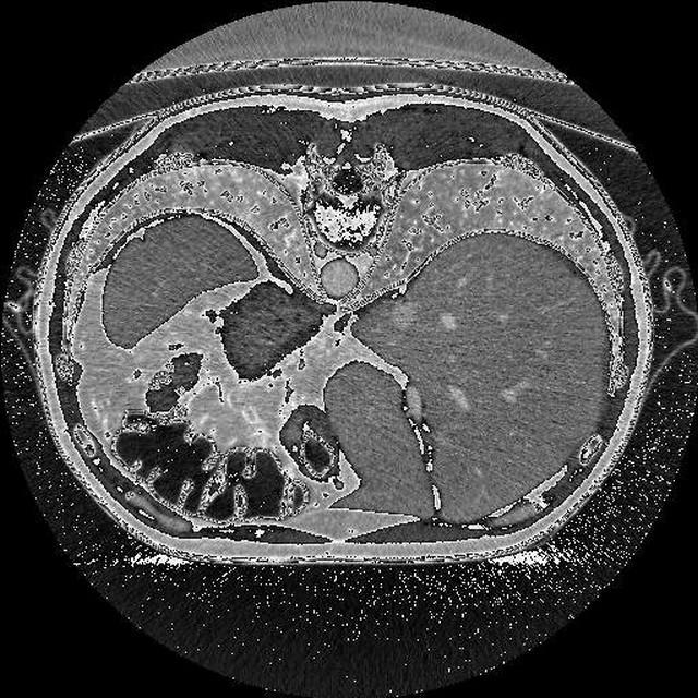 Lung Cancer Segmentation Instance Segmentation Dataset And Pre Trained