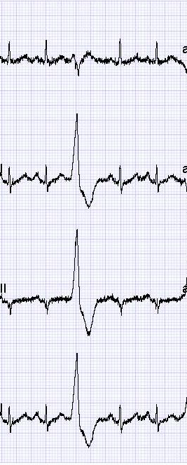 Ecg Signal Object Detection Dataset And Pre Trained Model By Innovation Lab