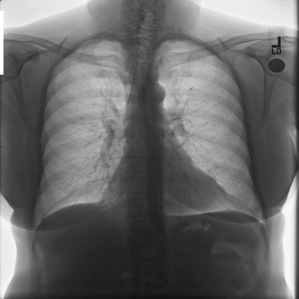 Apical_thickening Instance Segmentation Dataset by innovation lab