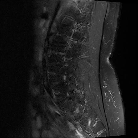 Lumbar Segmentation Instance Segmentation Dataset by Yatharths workspace