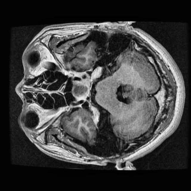 Cancer of brain Instance Segmentation Model by tahaMIR