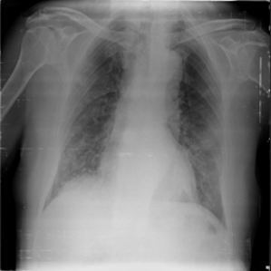 corona Classification Dataset and Pre-Trained Model by CIT