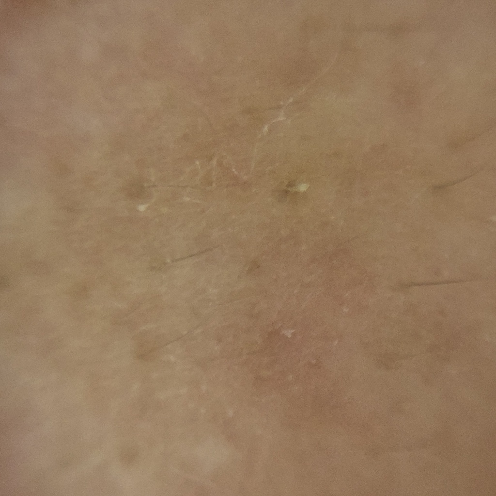 skin pore Object Detection Dataset by imstarter