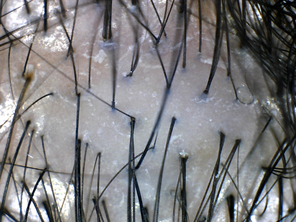 Hair Follicle 2 Object Detection Model by imstarter