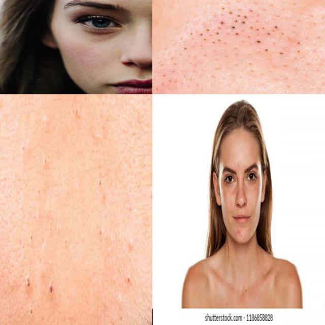 SKIN ANALYSIS Instance Segmentation Dataset by CLASS