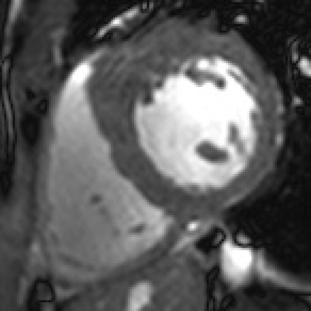 Cardio Segemtation 3 Instance Segmentation Dataset And Pre Trained