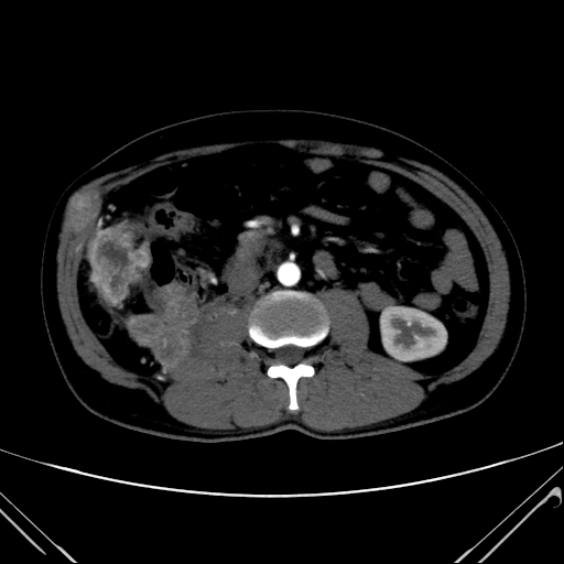 renal ct scans Classification Dataset by object detection