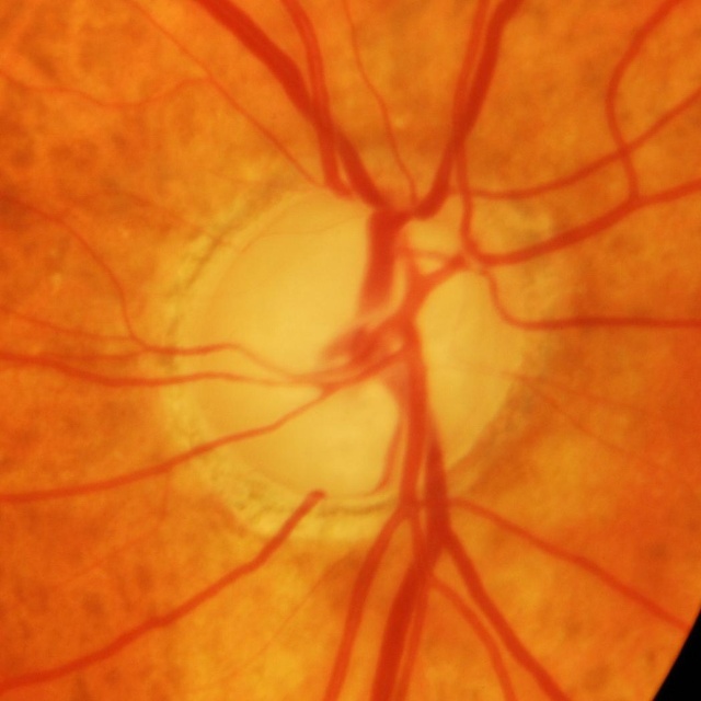 Glaucoma Detection Object Detection Dataset By Glaucoma Project 2895