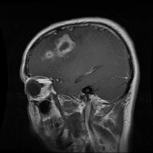 Tumor Detection2 Object Detection Dataset And Pre Trained Model By Alper