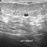 How to Use the BREAST SEGMENTATION Instance Segmentation API
