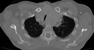 How to Use the Lung Cancer detection usign yolo v5n Object Detection API