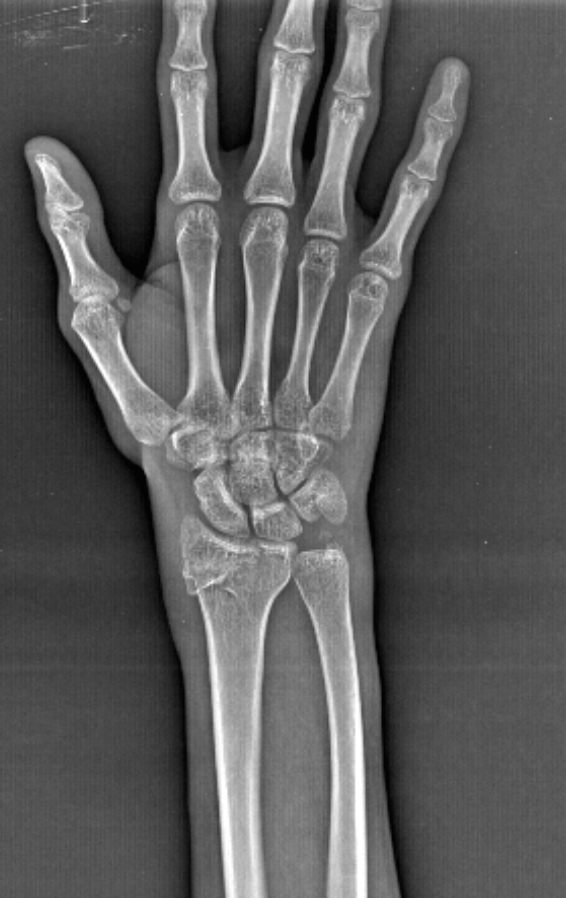 Wrist-Train-complete Object Detection Dataset by graduation project