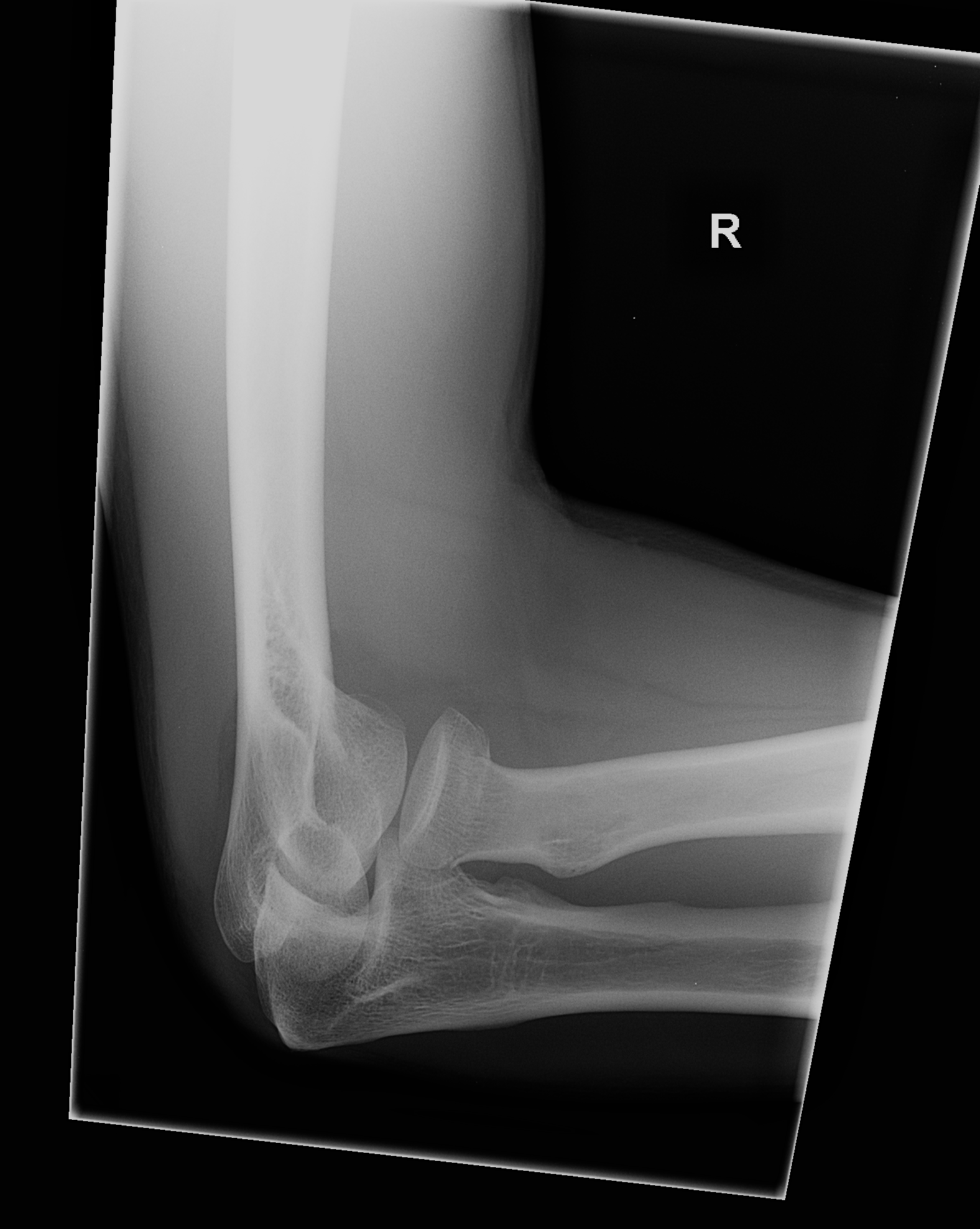 Fractures Segmentation Object Detection Dataset By Graduation Project