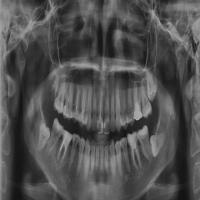 Dental Radiology Project - Roboflow Universe