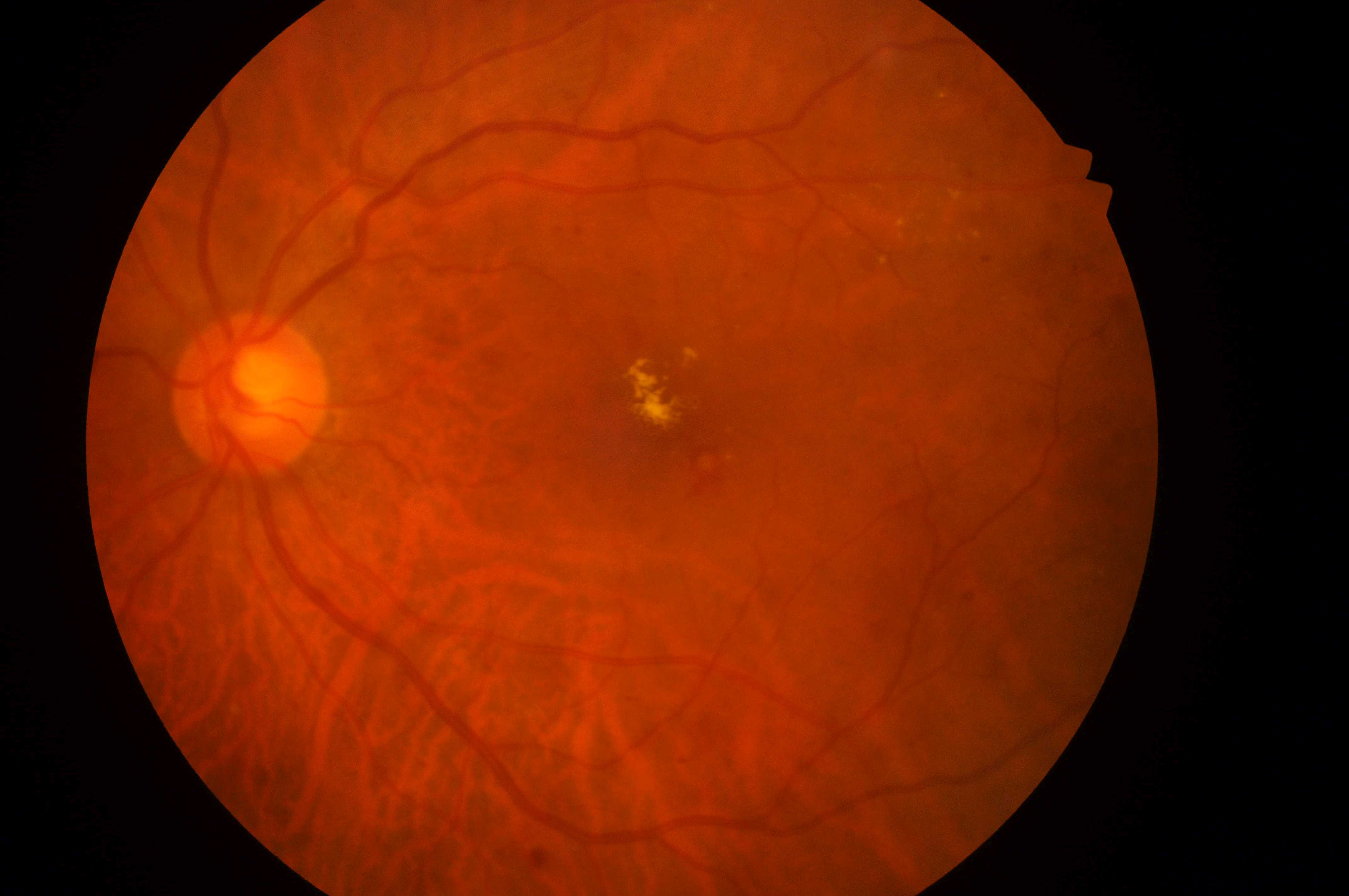 Diabetic Retinopathy Classification Dataset and Pre-Trained Model by DR ...