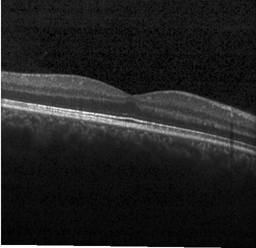 Retinal OCT Images Object Detection Dataset by Ploychompu