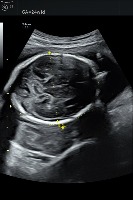 Brain Segmentation Masks - Roboflow Universe