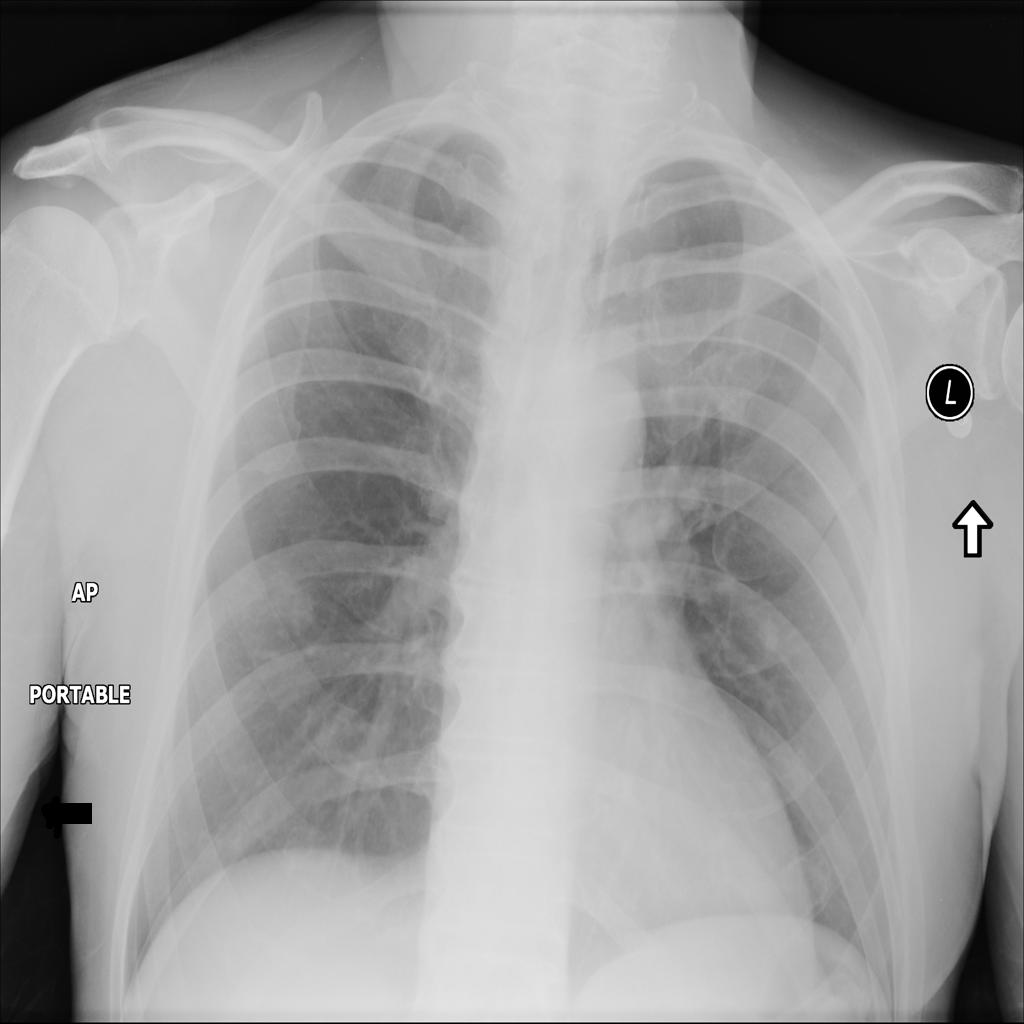 Cxr Object Detection Dataset By Xray Chest Nodule