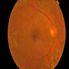 How to Use the Diabetes Detection by Retinal Classification API