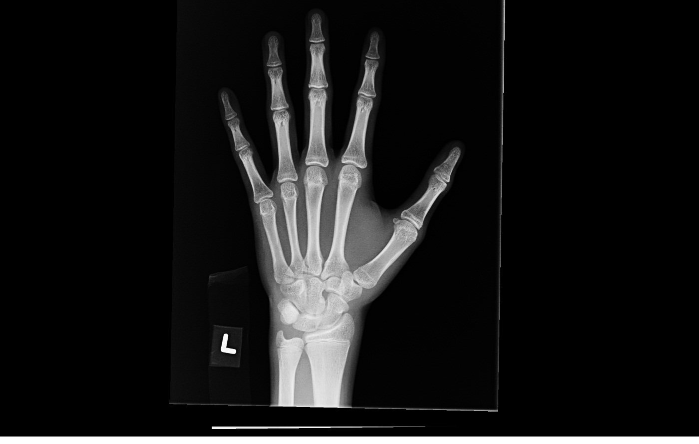 NEW HAND XRAY Object Detection Dataset by Martsenko