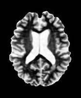 Brain MRI preprocessing Classification Dataset and Pre-Trained Model by ...