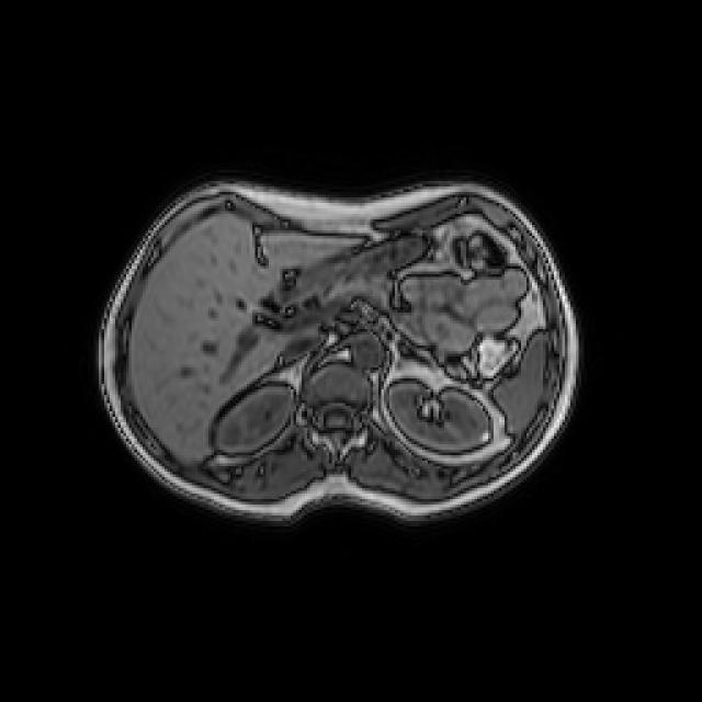 Liver Tumor Object Detection Dataset by Liver2