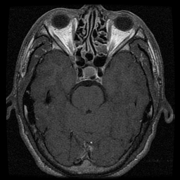 Brain_tumor Object Detection Dataset and Pre-Trained Model by Yolo v11